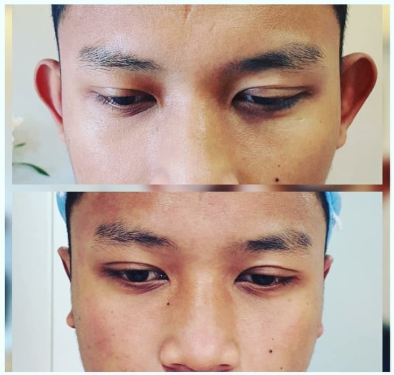 PLASTIC SURGERY REPAIR OF PROMINENT EAR ( OTOPLASTY) - Aesthetics ...