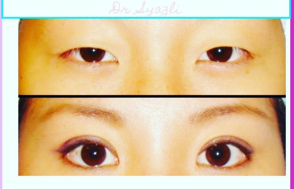 WHAT ARE THE TYPE DOUBLE EYELID SURGERY? - Aesthetics Leaders Malaysia